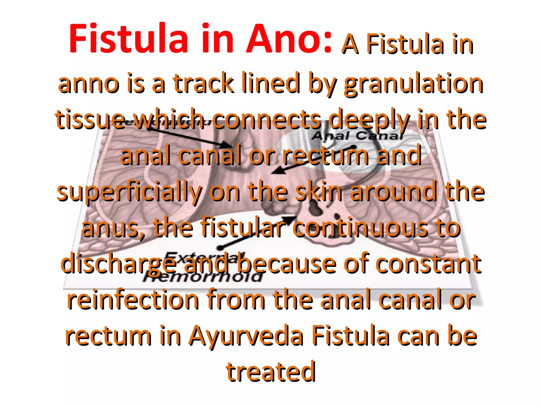 Piles fissures fistula | PPT