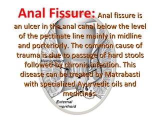 Piles fissures fistula | PPT