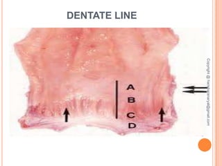 Piles, fistula management via kshar sutra method | PPTX