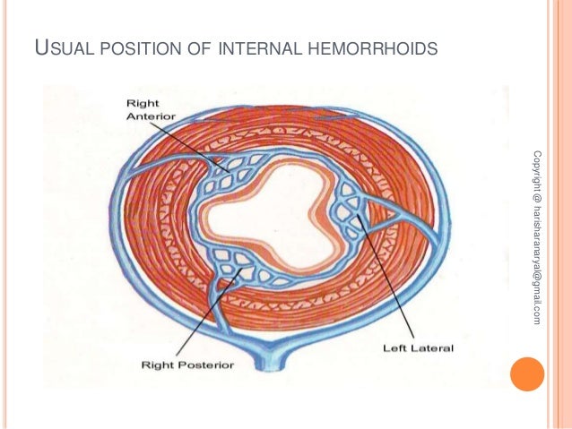 Piles, fistula management via kshar sutra method