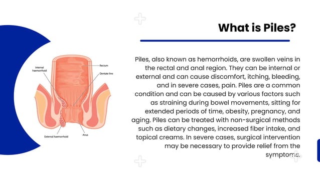 Trustworthy Piles Surgery by Dr. Gautam Nadkarni - Expertise and Compassion Combined | PPTX ...