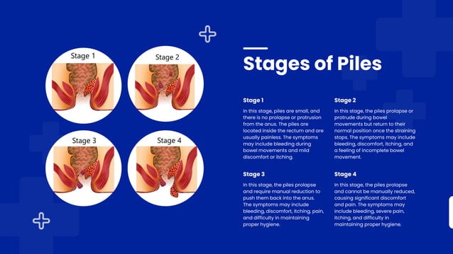 Trustworthy Piles Surgery by Dr. Gautam Nadkarni - Expertise and Compassion Combined | PPTX ...