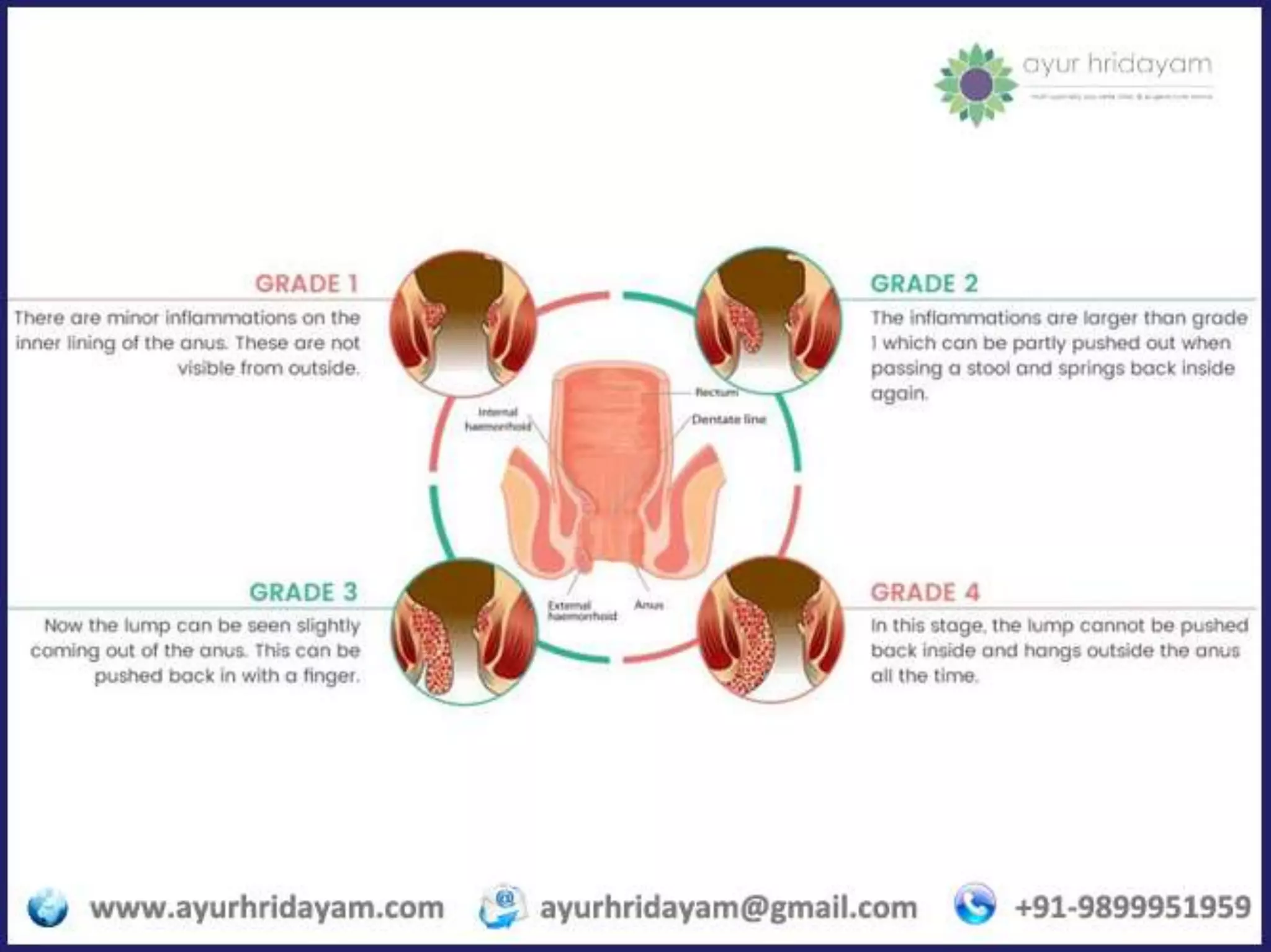 Piles treatment at ayur hridayam | PPT