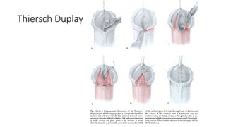 Pilihan Teknik Operasi berdasarkan Letak Hipospadia.pptx