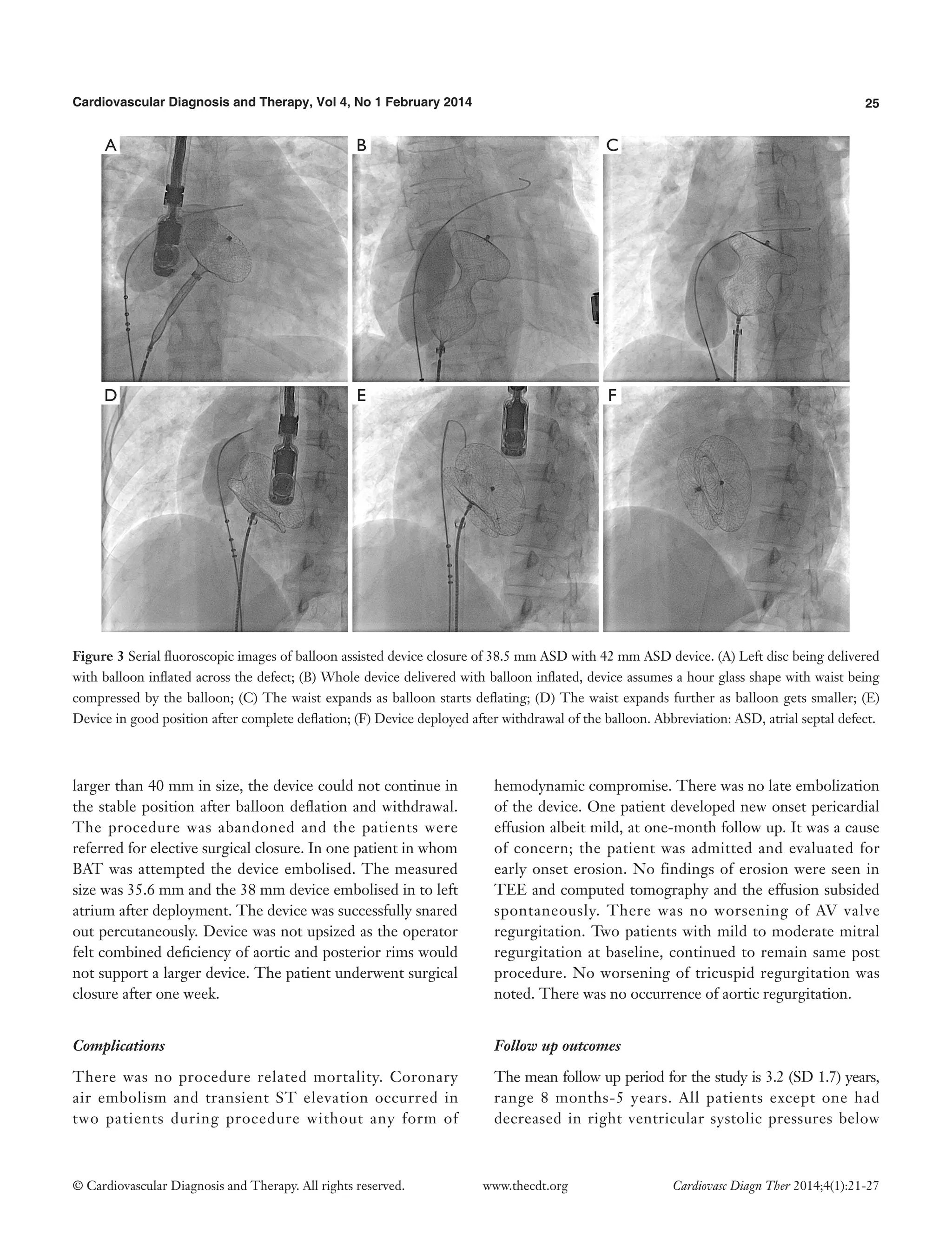 Utility of balloon assisted technique in trans catheter closure of very ...