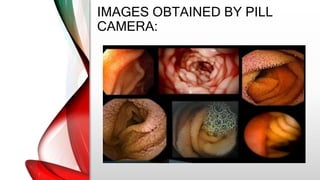 pill cam.pptx