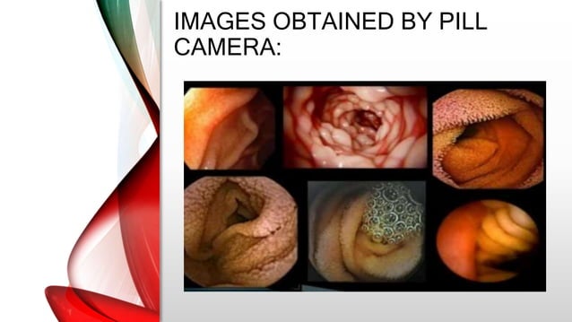 pill cam.pptx