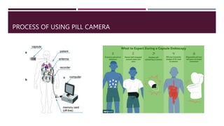 Pill camera.pptx | Digestive Disorders | Diseases and Conditions