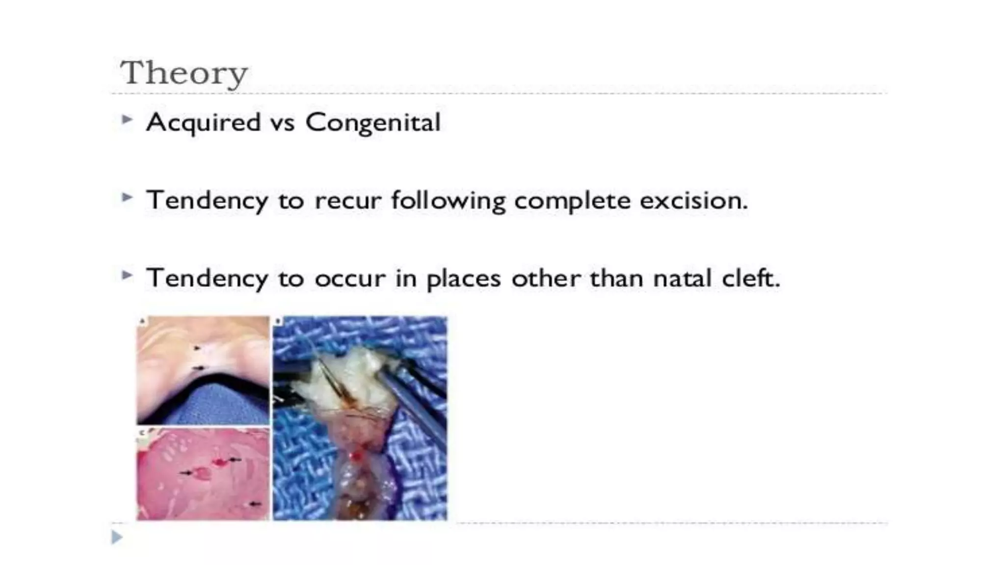Pilonidal sinus disease | PPTX