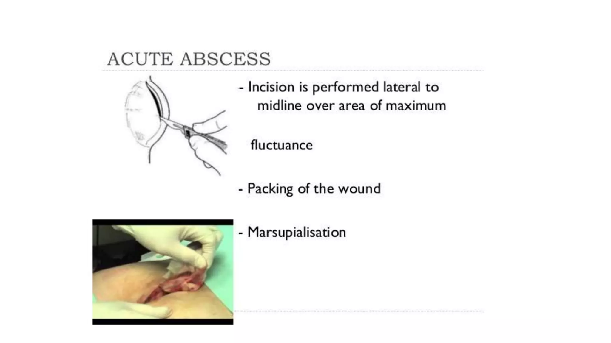 Pilonidal sinus disease | PPTX