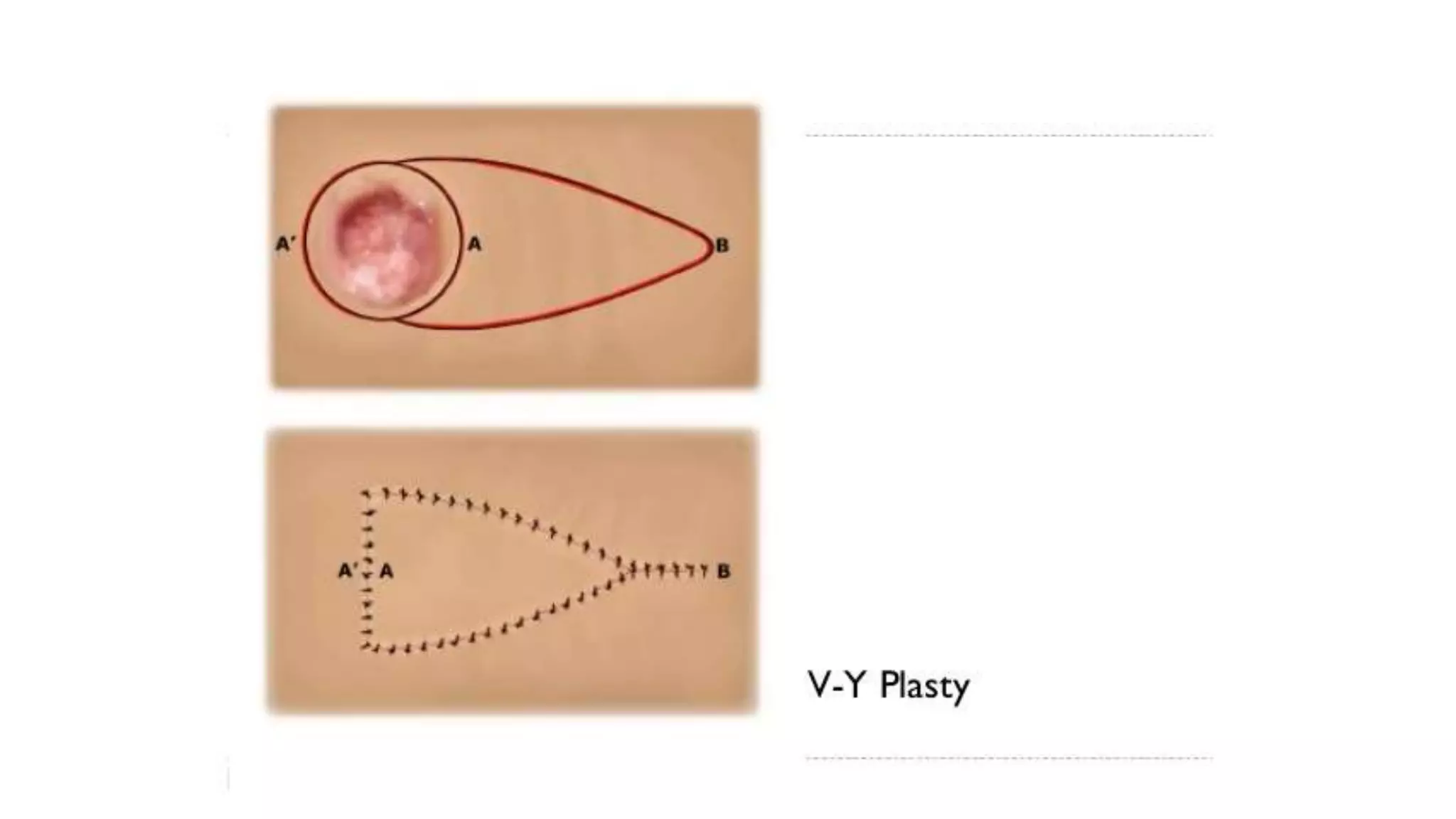 Pilonidal Sinus Disease Pptx