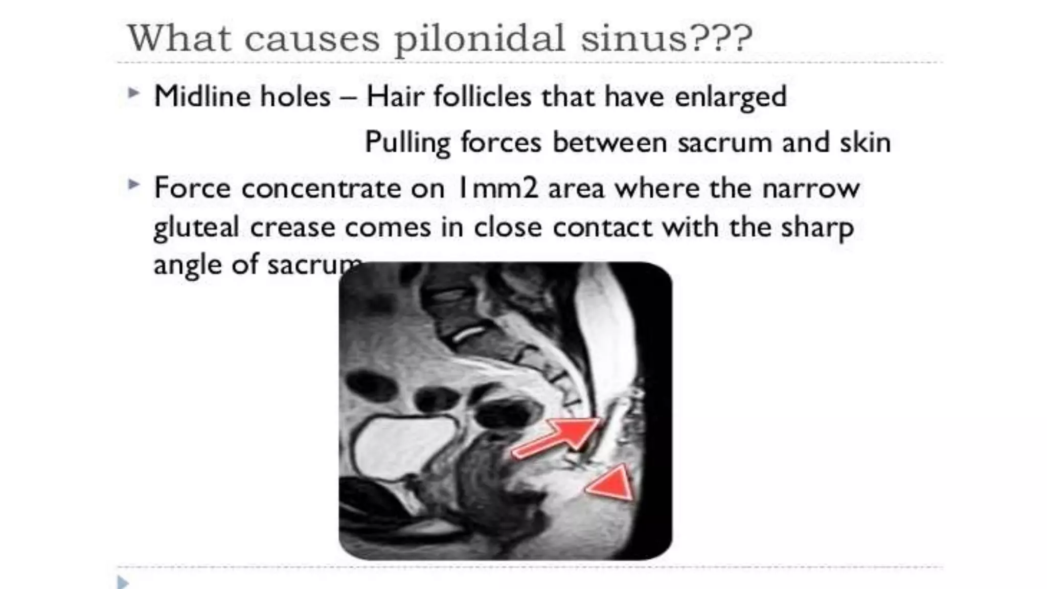 Pilonidal sinus disease | PPTX