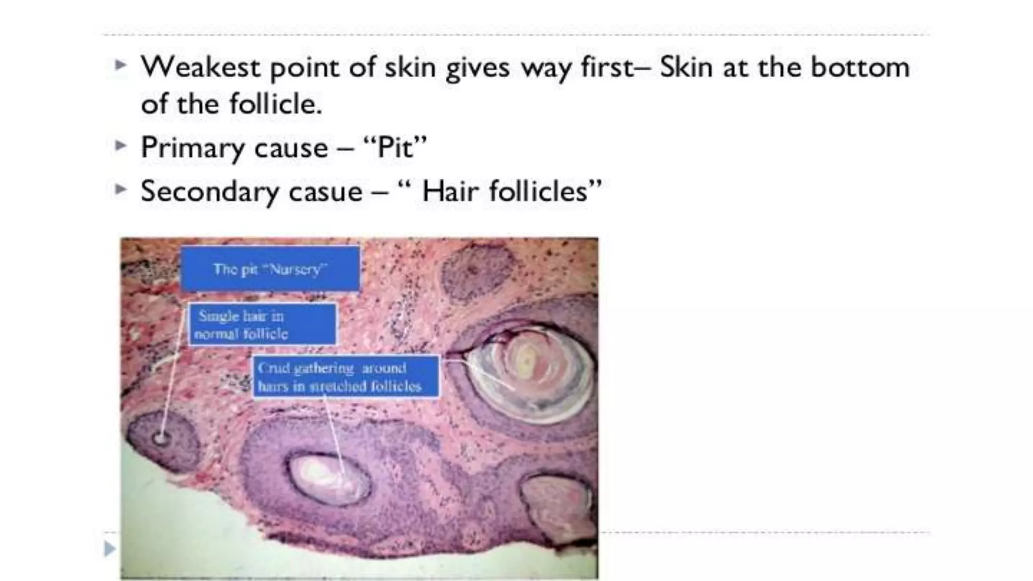Pilonidal sinus disease | PPTX