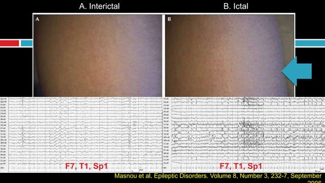 Piloerection in epilepsy | PPT