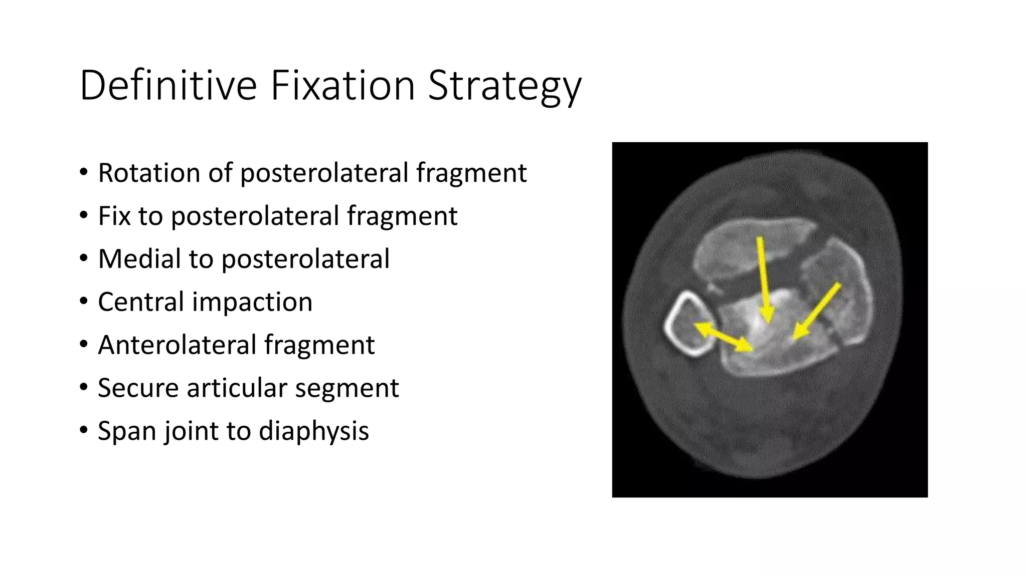 Ankle Fracture :Pilon Map Column Concept | PPTX