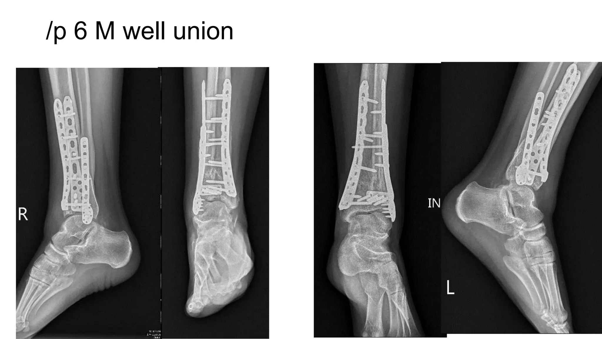 Ankle Fracture :Pilon Map Column Concept | PPTX