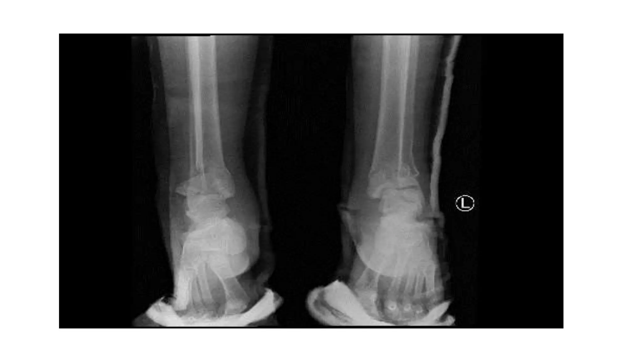 Ankle Fracture :Pilon Map Column Concept | PPTX