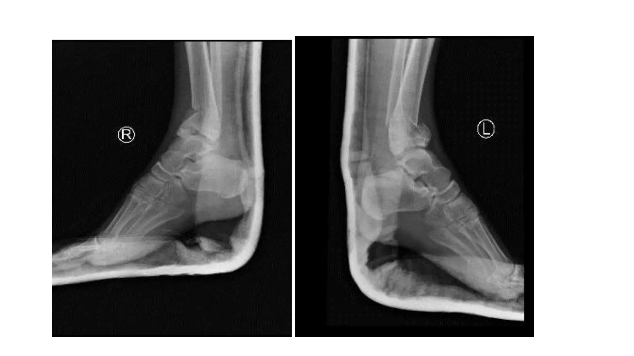 Ankle Fracture :Pilon Map Column Concept | PPTX