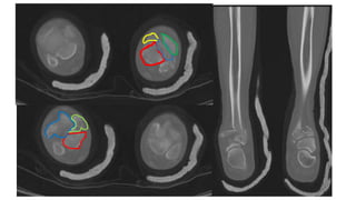 Ankle Fracture :Pilon Map Column Concept | PPT