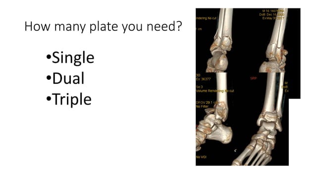Ankle Fracture :Pilon Map Column Concept | PPT