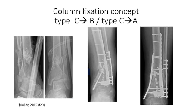 Ankle Fracture :Pilon Map Column Concept | PPT