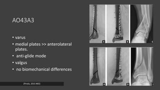 Ankle Fracture :Pilon Map Column Concept | PPTX
