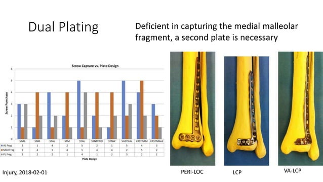 Ankle Fracture :Pilon Map Column Concept | PPT