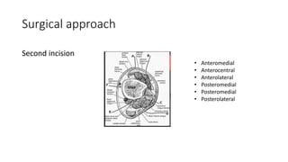 Ankle Fracture :Pilon Map Column Concept | PPT