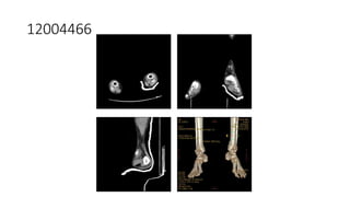 Ankle Fracture :Pilon Map Column Concept | PPT
