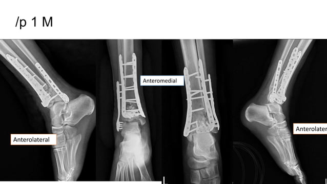 Ankle Fracture :Pilon Map Column Concept | PPT