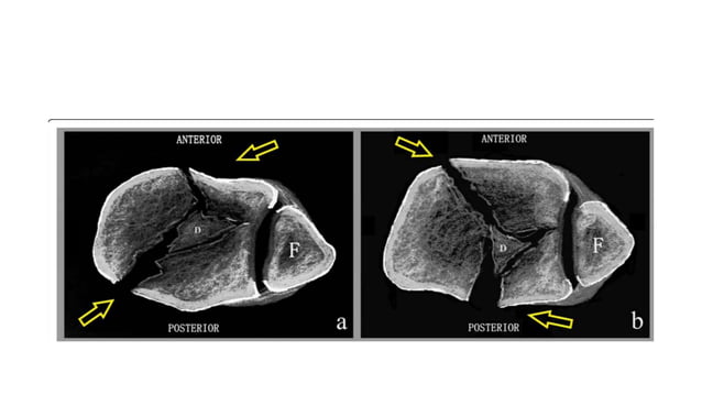 Ankle Fracture :Pilon Map Column Concept | PPT