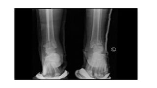 Ankle Fracture :Pilon Map Column Concept | PPTX