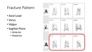 Ankle Fracture :Pilon Map Column Concept | PPT
