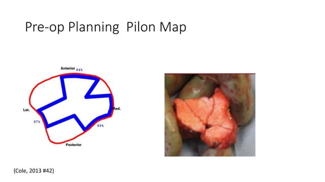 Ankle Fracture :Pilon Map Column Concept | PPT