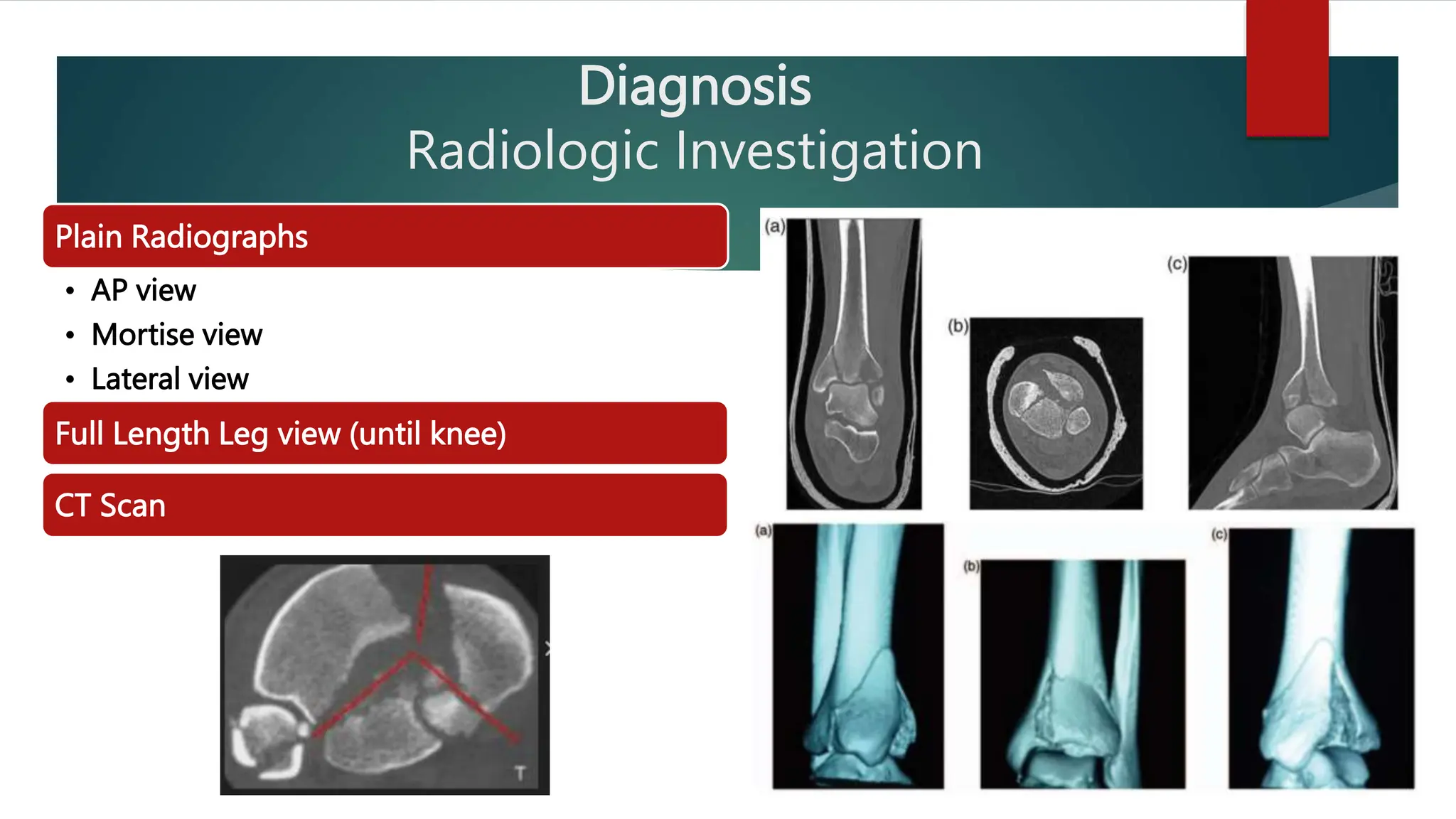 Diagnosis and Management of Tibial Plafond / Pilon Fracture.pptx