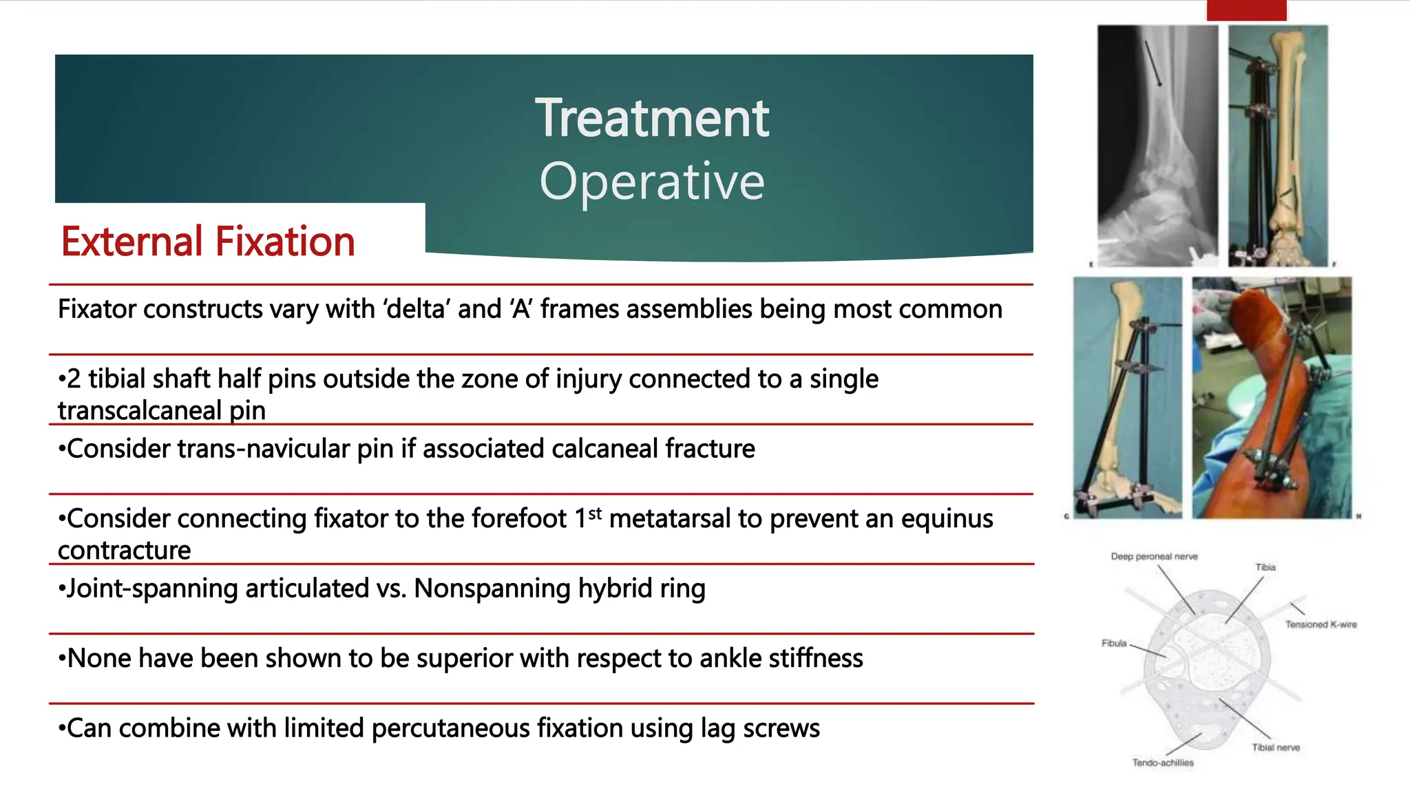 Diagnosis and Management of Tibial Plafond / Pilon Fracture.pptx