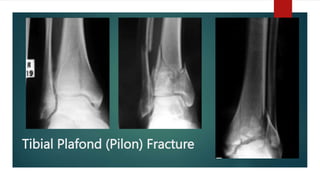 Diagnosis and Management of Tibial Plafond / Pilon Fracture.pptx
