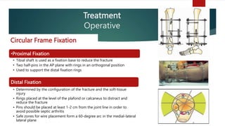 Diagnosis and Management of Tibial Plafond / Pilon Fracture.pptx