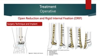 Diagnosis and Management of Tibial Plafond / Pilon Fracture.pptx