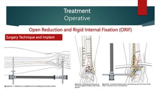 Diagnosis and Management of Tibial Plafond / Pilon Fracture.pptx