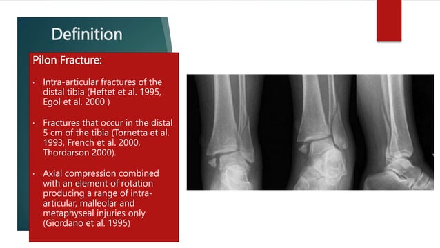 Diagnosis and Management of Tibial Plafond / Pilon Fracture.pptx