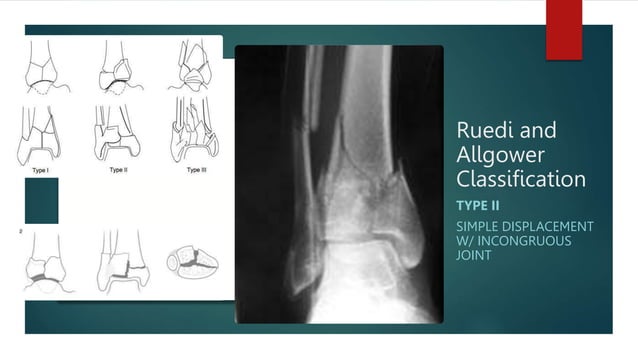 Diagnosis and Management of Tibial Plafond / Pilon Fracture.pptx