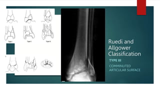 Diagnosis and Management of Tibial Plafond / Pilon Fracture.pptx
