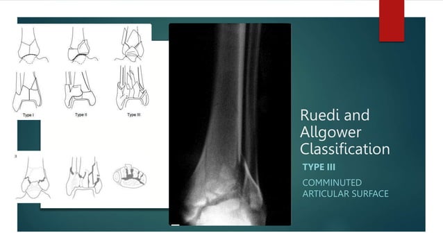 Diagnosis and Management of Tibial Plafond / Pilon Fracture.pptx