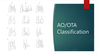 Diagnosis and Management of Tibial Plafond / Pilon Fracture.pptx