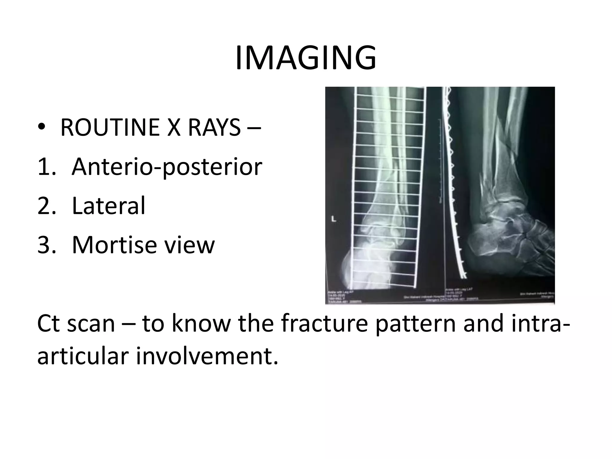 Pilon fracture | PPTX