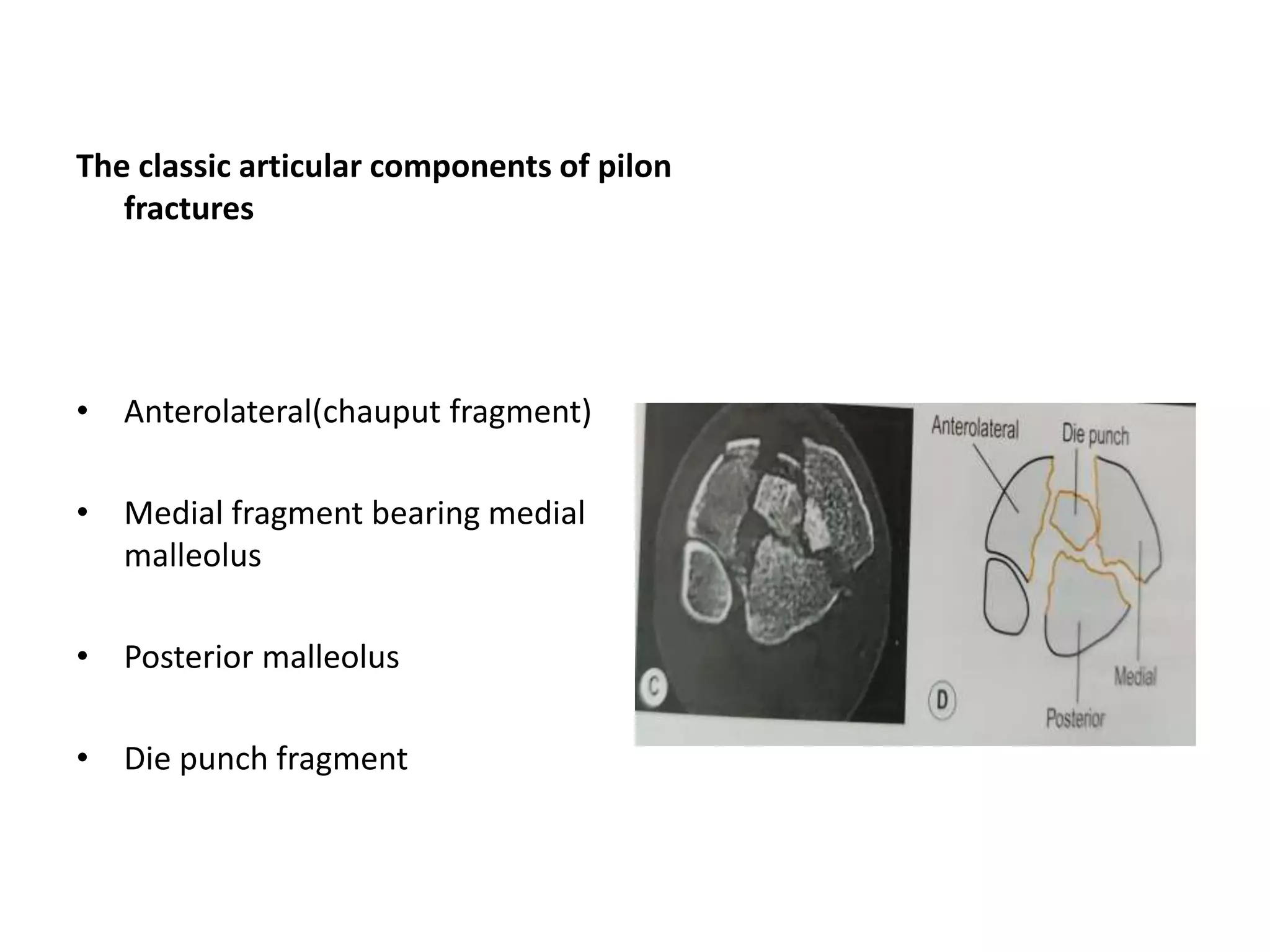 Pilon fracture | PPTX
