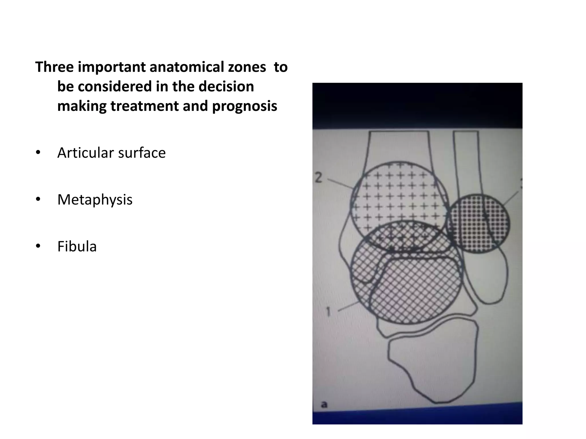 Pilon fracture | PPTX