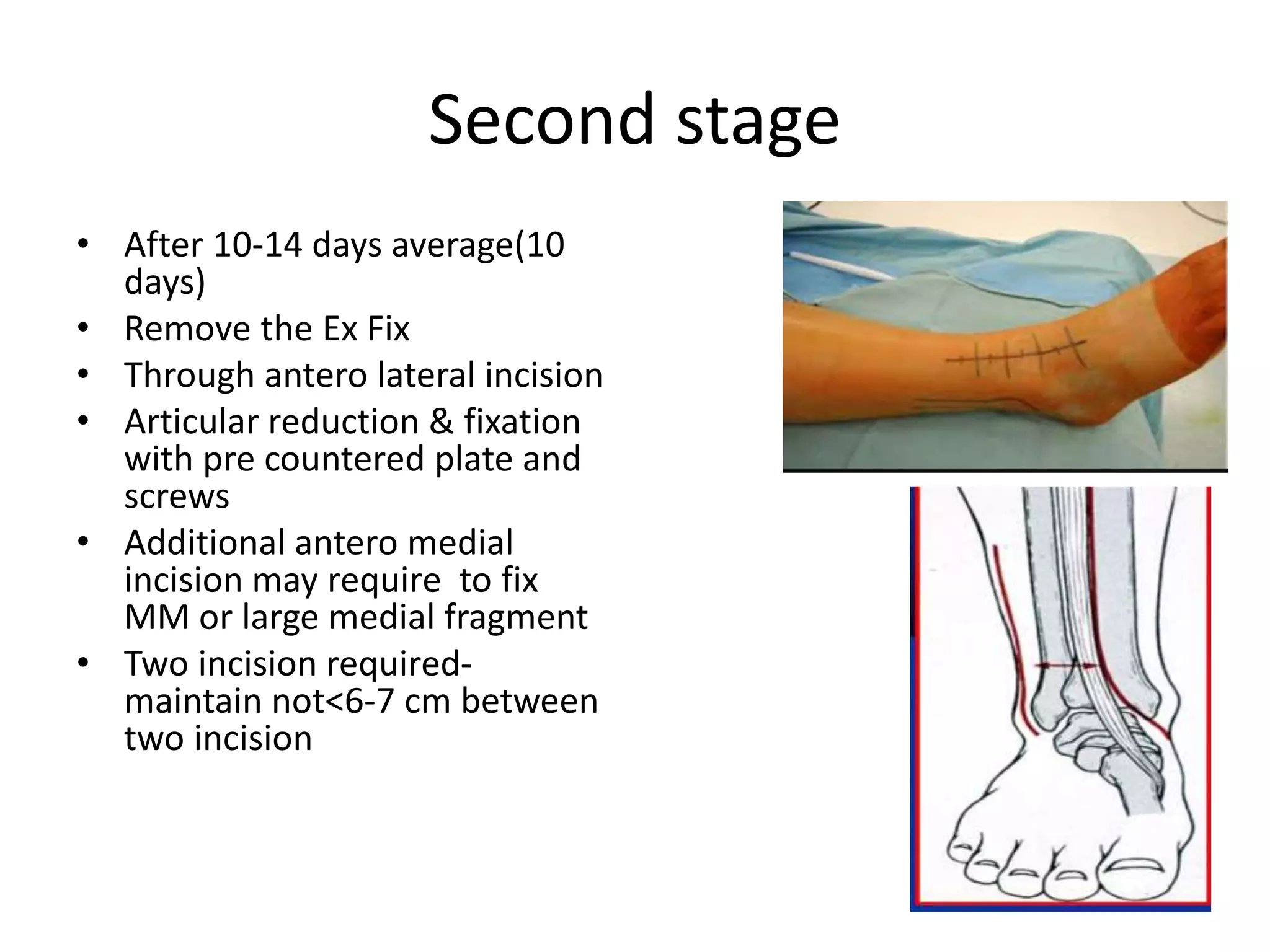 Pilon fracture | PPTX