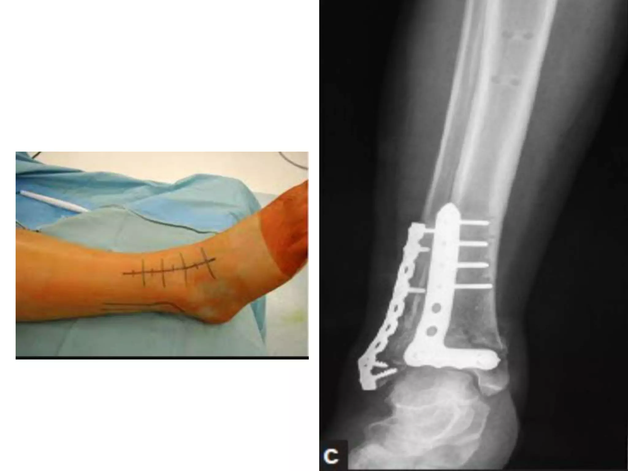 Pilon fracture | PPTX